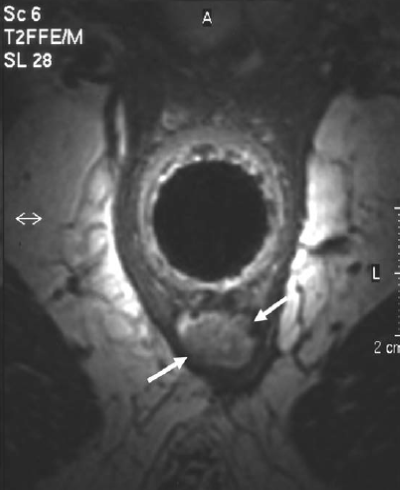 Anorectal Abscess | Dr. Shashikant S Jadhav