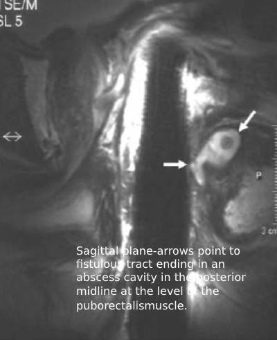Anorectal Abscess | Dr. Shashikant S Jadhav